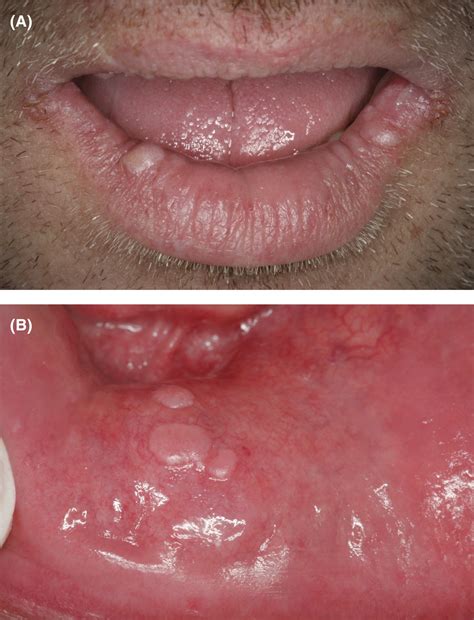 The Role Of Viruses In Oral Mucosal Lesions Dommisch 2024