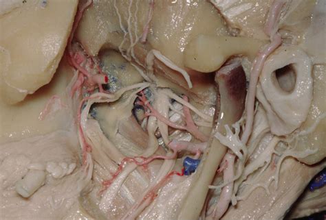 Lateral View Of The Infratemporal Fossa Neuroanatomy The Neurosurgical Atlas