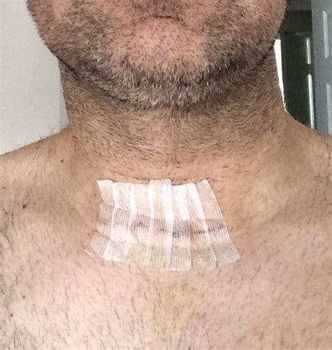 Recovering From A Total Thyroidectomy Papillary Thyroid Cancer