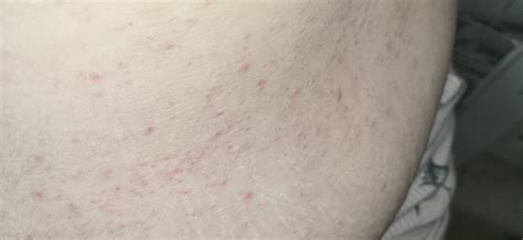 Сыпь на животе 3 дня назад появилась сыпь на животе и не много яешется Medaboutme