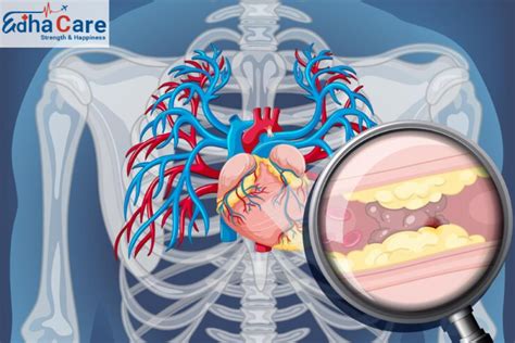 Myocardial Bridge Symptoms Signs And Diagnosis