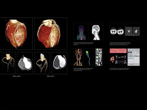 Ultrafast Multislice Ct Scan Gic Prime