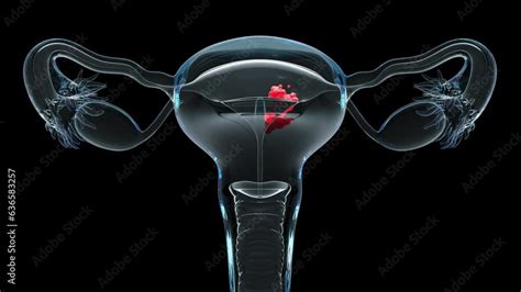 Stockvideon Uterus Malignant Tumor Female Uterus Anatomy Reproductive