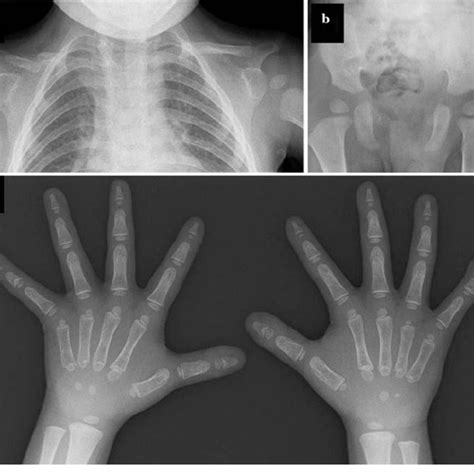 Pdf A Novel In Frame Deletion Of The Runx2 Gene Causes A Classic Form