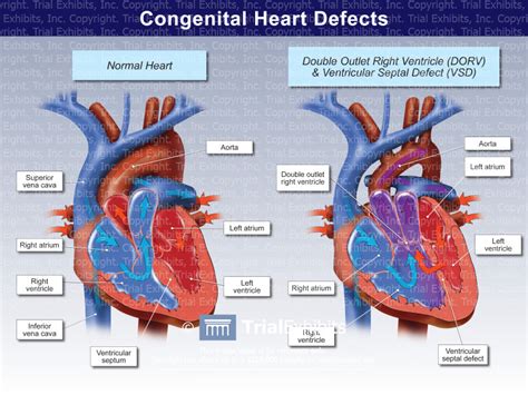Congenital Heart Defects Trialquest Inc