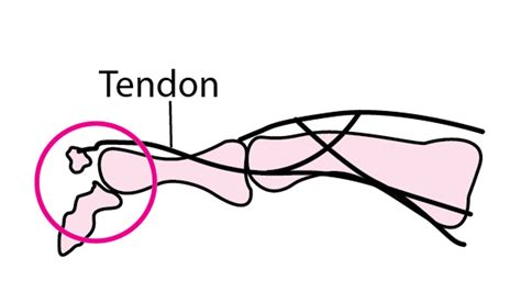 Image Avulsion Fracture Of The Finger Msd Manual Consumer Version