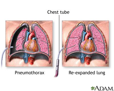 Pneumothorax SeriesIncision MedlinePlus Medical Encyclopedia