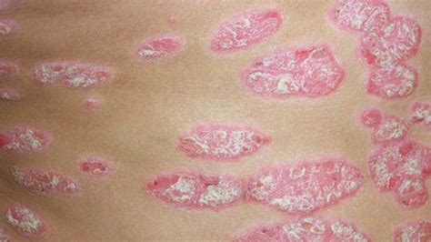10 Skin Rashes Caused By Ulcerative Colitis