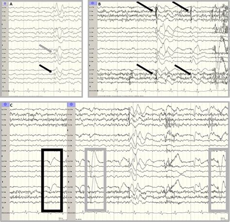 Reading Epilepsy And Language Processing A Proposed Role Fo Journal Of Clinical