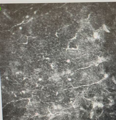 Rolando Toyos Md On Linkedin Dry Eye Disease Patients And Cornea