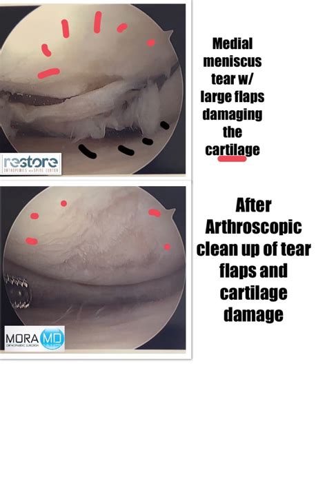 What Makes A Meniscus Tear Bad