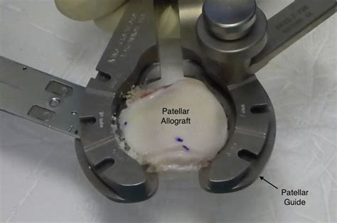 Right Patellar Graft Preparation The Articular Side Of The Patella Is