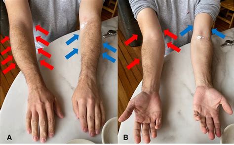 Isolated Rhabdomyolysis Of Long Head Of Triceps Mimicking Upper