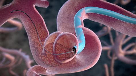 Pipeline Embolization Device On Behance