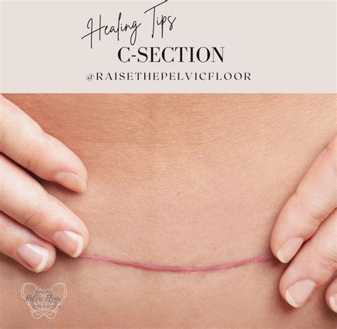 C Section Cuts 6 Layers Raise The Pelvic Floor