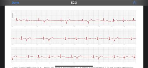 Pvcs Happening For A Week Almost Every Night Before Bed And Driving Me Nuts Rpvcs
