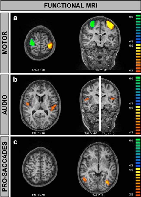 Structural Mri Bold Activations A In The Motor Task Leftsided Finger