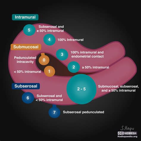 Uterine Leiomyoma Fibroid Classification System Illustration Radiology Case Radiopaedia
