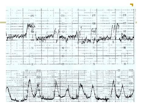 Cardiotocography Ctg Ppt Pregnancy Reproductive Health