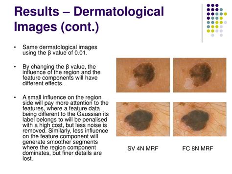 PPT Segmentation Of Dermatological Images Using Mixture Models And Markov Random Fields