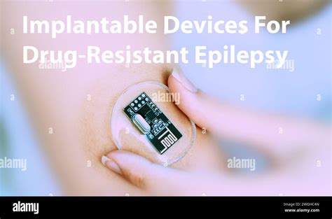 Implantable Devices For Drug Resistant Epilepsy Devices That Deliver