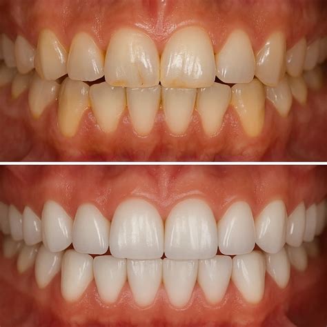 🦷 What Is Occlusion In Dentistry A Complete Guide To Types Lema