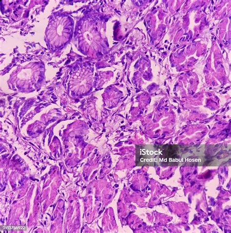 Microscopic Image Of Stomach Body Hyperplastic Polyp Show Gastric Mucosa Polypoid Growth Of Microscopic Image Of Stomach Body Hyperplastic Polyp Show Gastric Mucosa Polypoid Growth Of