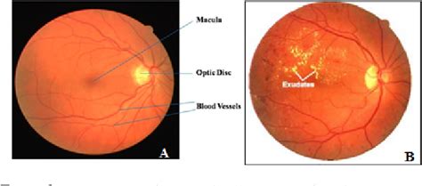 Figure 1 From An Efficient Approach For Detecting Exudates In Diabetic Retinopathy Images
