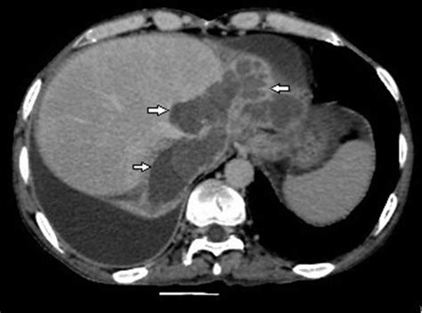 Hepatic Artery Pseudoaneurysm A Life Threatening Complication Of Liver
