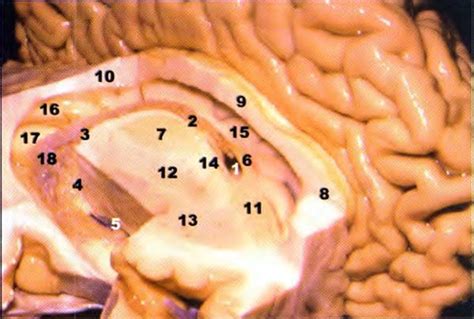 Infartos De La Arteria Coroidea Anterior Controversias En La Anatomía