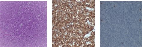 Immunophenotypic Characterisation Of Non Hodgkin Lymphomas At A