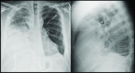 Pa And Lateral Cxr Showing Expanding Pleural Effusion Despite