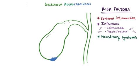 Tumors Of The Gallbladder And Bile Ducts Hepatic And Biliary