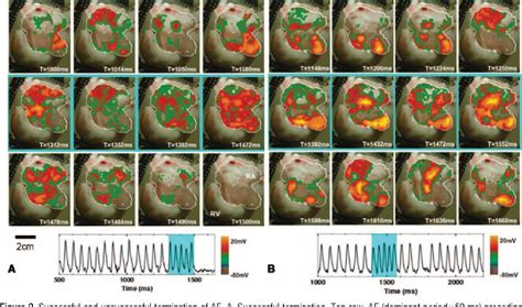 Figure 2 From Termination Of Atrial Fibrillation Using Pulsed Low Energy Far Field Stimulation