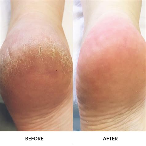 Foot Filer Dermave