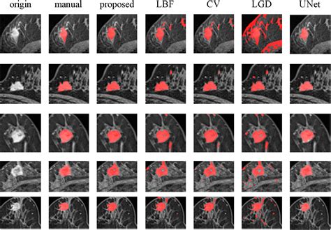 Active Contour Model Of Breast Cancer Dce‐mri Segmentation With An Extreme Learning Machine And