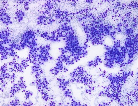 Pathology Outlines Oncocytic