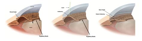 Glaucoma Information Occludable Angle Glaucoma Information