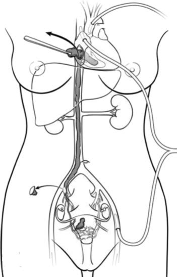 Intracardiac Extension Of Intravenous Leiomyomatosis The Annals Of