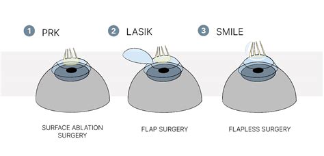 Introduction To Refractive Eye Surgery Journal Of The Foundations Of