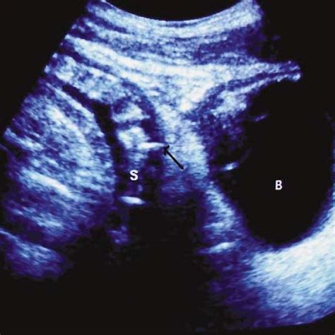 Colonoscopy Shows Inflamed Granular Mucosa Of Sigmoid Colon Download Scientific Diagram