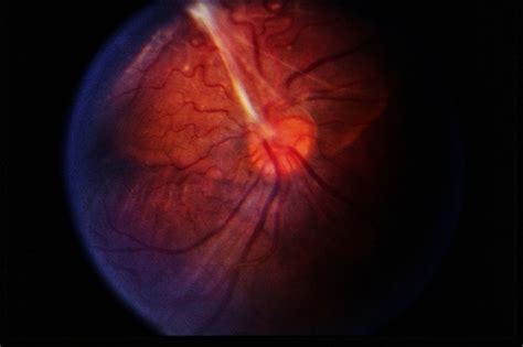 Toxocara Retina Image Bank