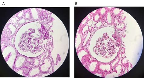 Glomerular Staining ×40 A Pas And B Hande Staining Mild
