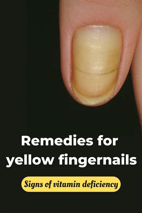 Iron Deficiency Signs Of Vitamin Deficiency In Nails At Chelsea
