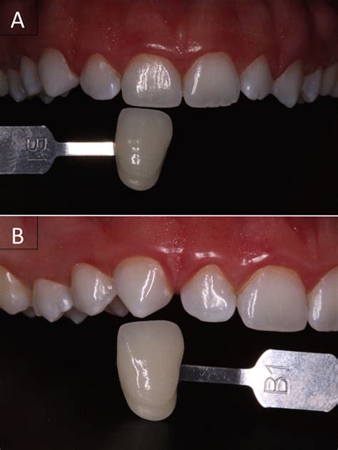 Clinical Application Of Violet Led In Office Bleaching With Or Without Traditional Systems Case