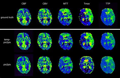 Synthesized Perfusion Parameter Maps Middle And Bottom Row Compared Download Scientific