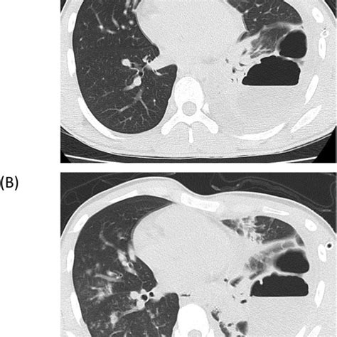 Intraoperative Findings During The Open Window Thoracostomy And Download Scientific Diagram
