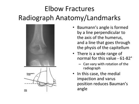 Classificaton Of Injuries Around Elbow Management Of Supracondylar