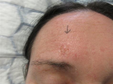 Basal Cell Carcinoma On Forehead Bcc Image Example Mr Tehrani