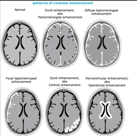 Dr Mati Ul Haq On Linkedin Meningeal Enhancement